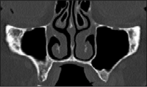 Sinus Anatomic Variants that Predispose Post-Implant Morbidity