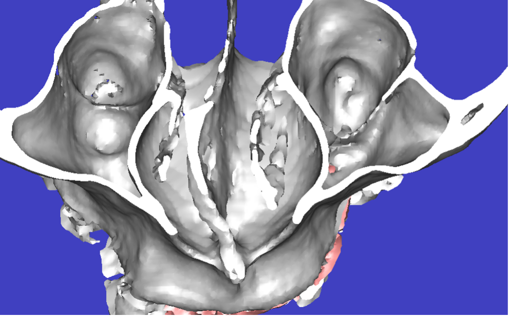 Sinus Anatomic Variants that Predispose Post-Implant Morbidity